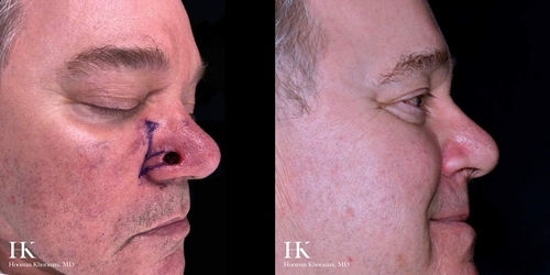 Before & After Photos Mohs Micrographic Surgery & Reconstruction ...