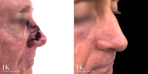 Before & After Photos Mohs Micrographic Surgery & Reconstruction ...