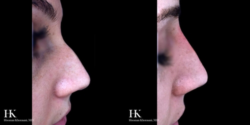 Before & After Photos Nose Reshaping (Non-Surgical Rhinoplasty ...