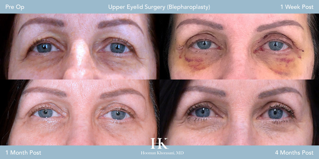 Things To Do To Prepare For Easy Recovery From Eyelid Surgery Ulrich