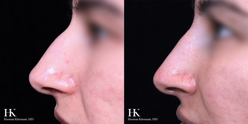 4 Nose Flaws That Can Be Corrected Without Surgery