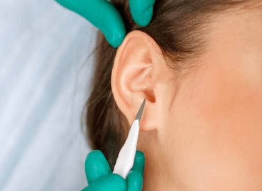 Ear Surgery | Ear Fold Treatment UK – Este Medical Group