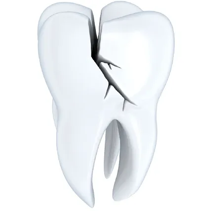 Trauma Treatment | Mickel Microsurgical Endodontics