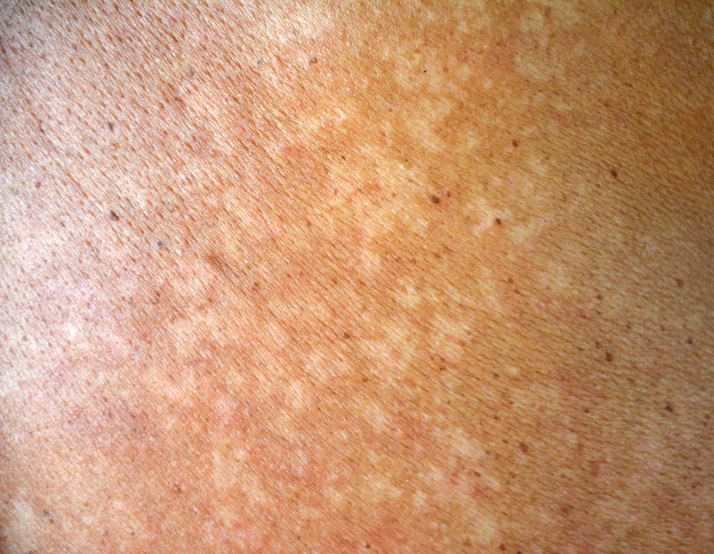 Flekker i huden på overkroppen - blitt tydelige etter soling? - Askin ...