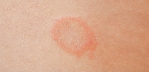 Ringorm – sopp i huden