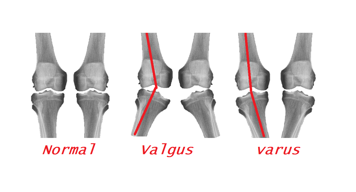 Painful Knee Joints can be a Thing of the Past