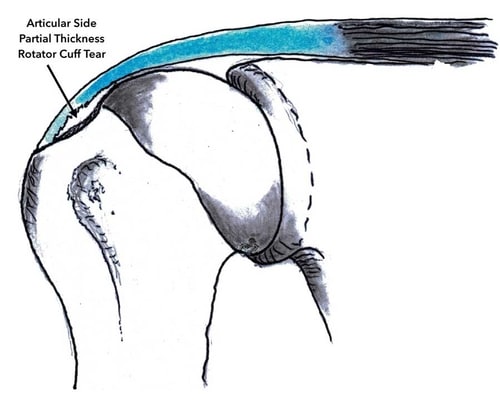 Rotator Cuff Tear - Shoulder Clinic