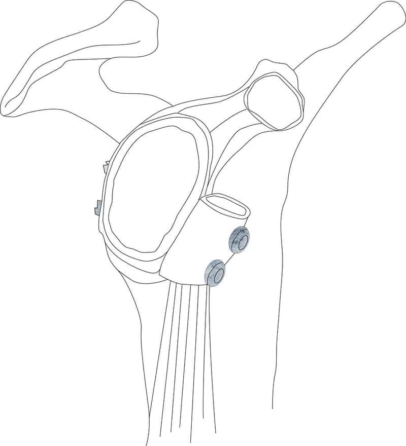Arthroscopic Latarjet & Labral Repair - Shoulder Clinic