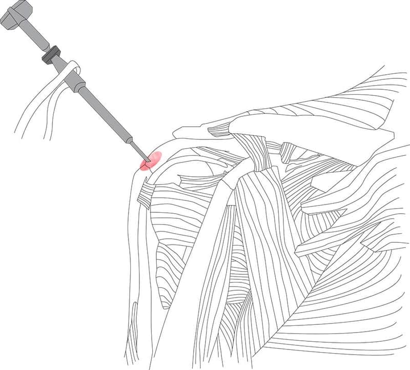 Arthroscopic Excision of Calcium - Shoulder Clinic
