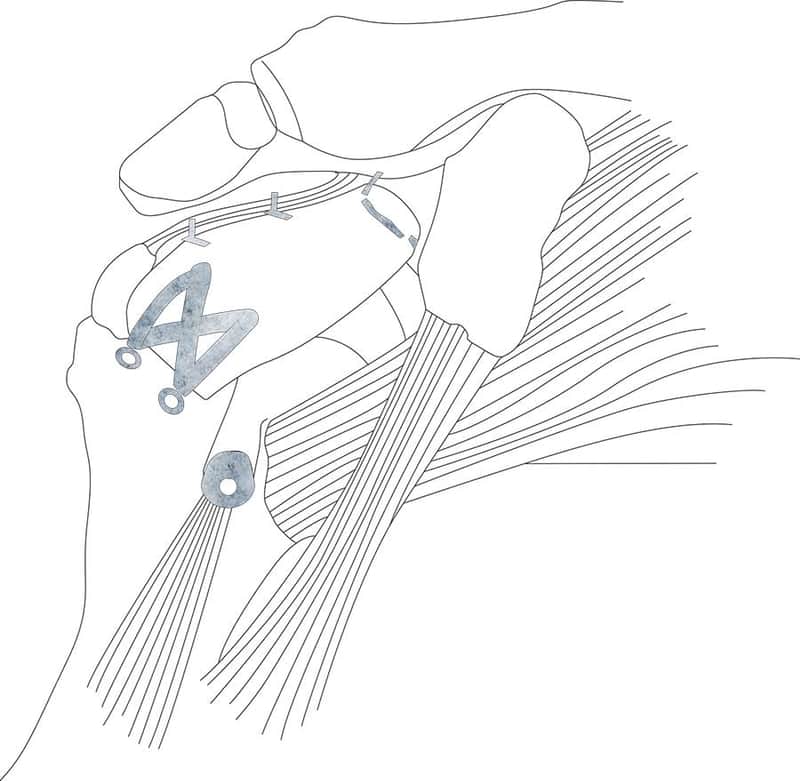 Superior Capsular Reconstruction - Shoulder Clinic