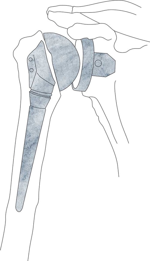 Total Shoulder Replacement - Shoulder Clinic