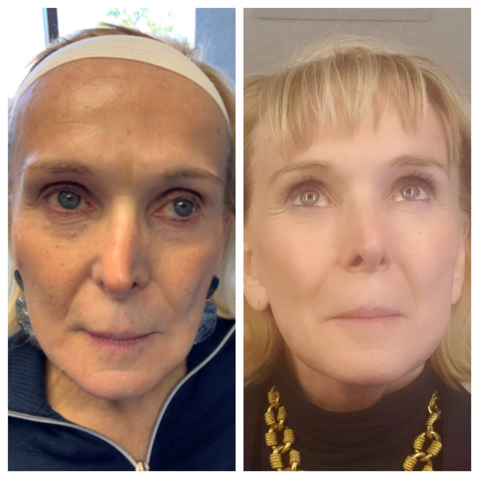 Silhouette Thread Lift | Krch AESTHETIC MEDICINE