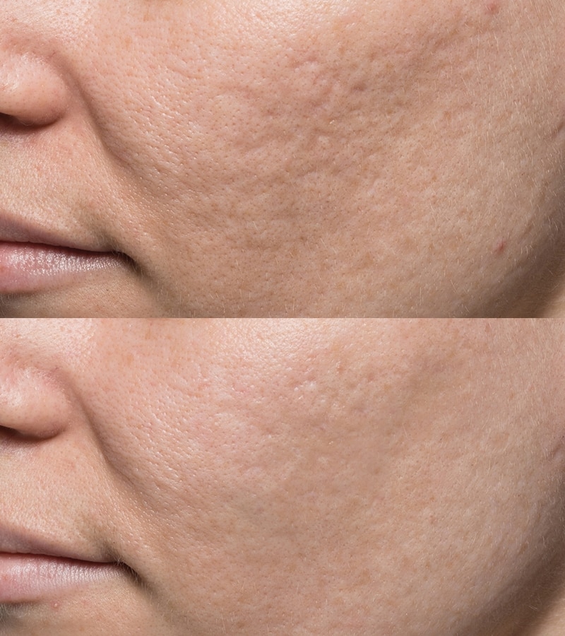 Bellafill Phoenix | Bellafill Injections | Anti-Wrinkle Injections