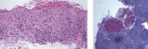Eosinofil esofagit – diagnostik