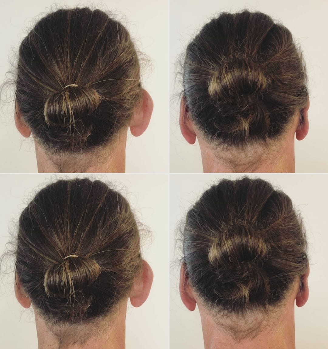 Suture Otoplasty | GMC Cosmedical Clinics, Sydney