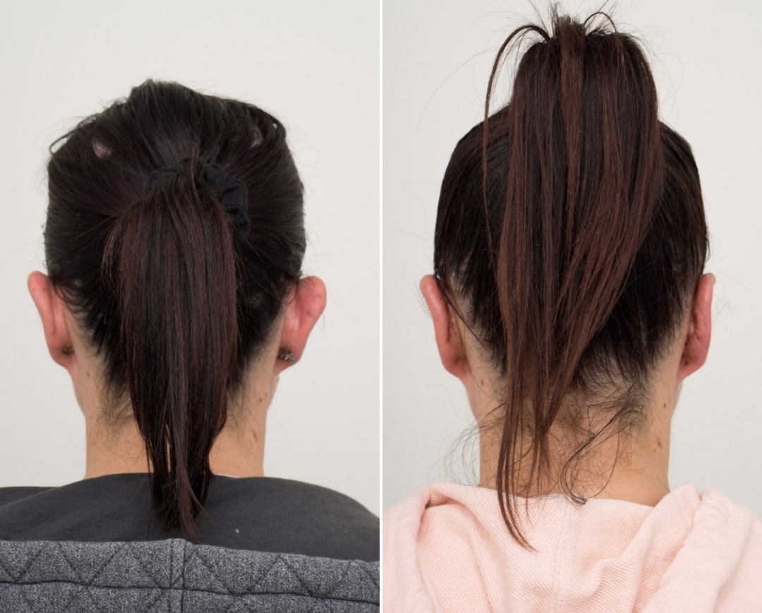 Suture Otoplasty | GMC Cosmedical Clinics, Sydney