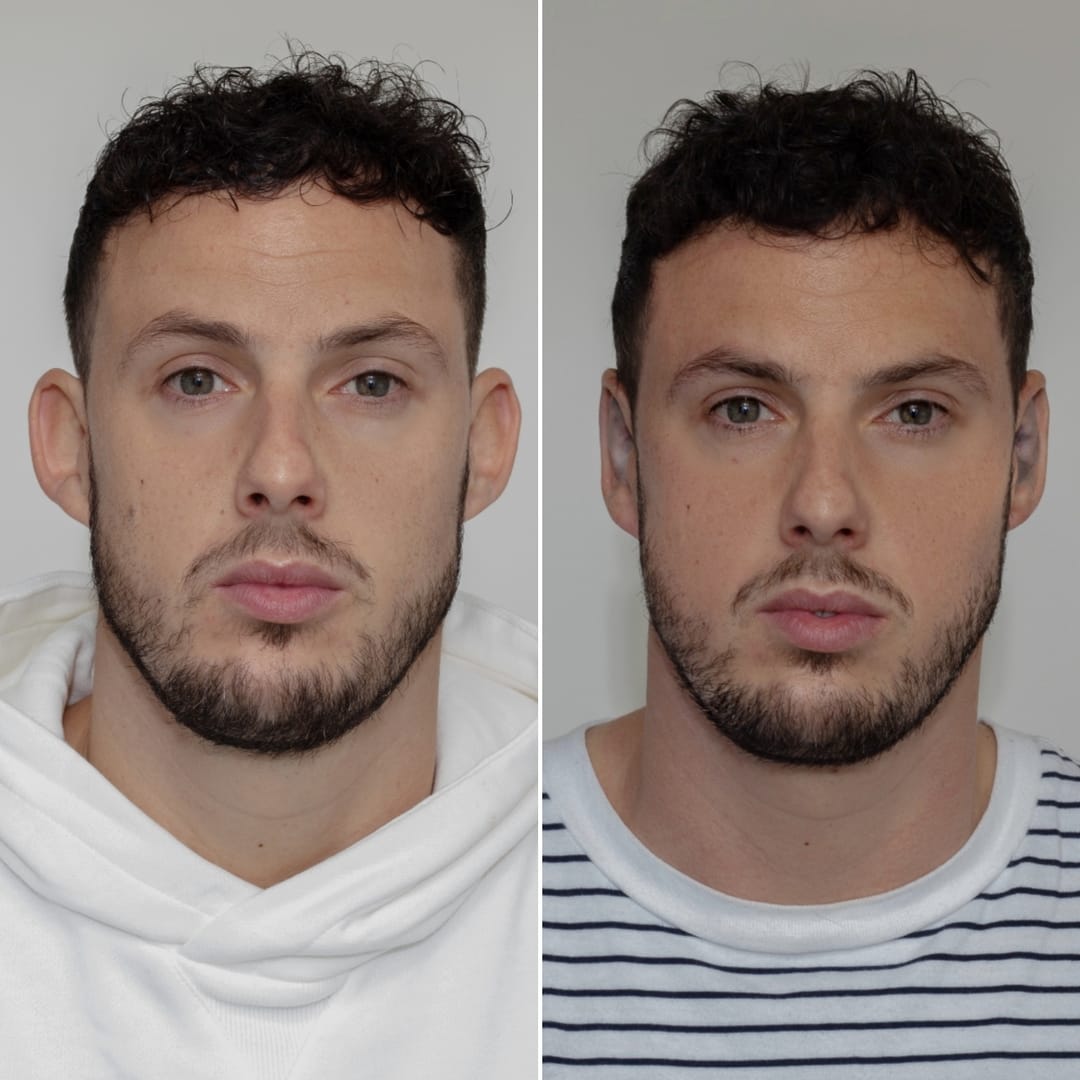 Suture Otoplasty | GMC Cosmedical Clinics, Sydney