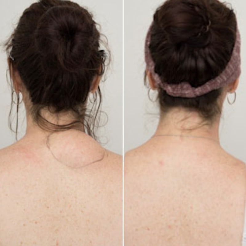 Lipoma removal | GMC Cosmedical Clinics, Sydney