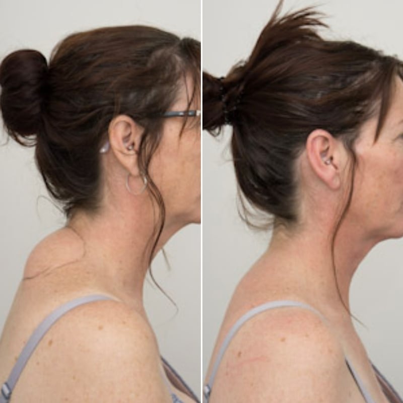 Lipoma removal | GMC Cosmedical Clinics, Sydney