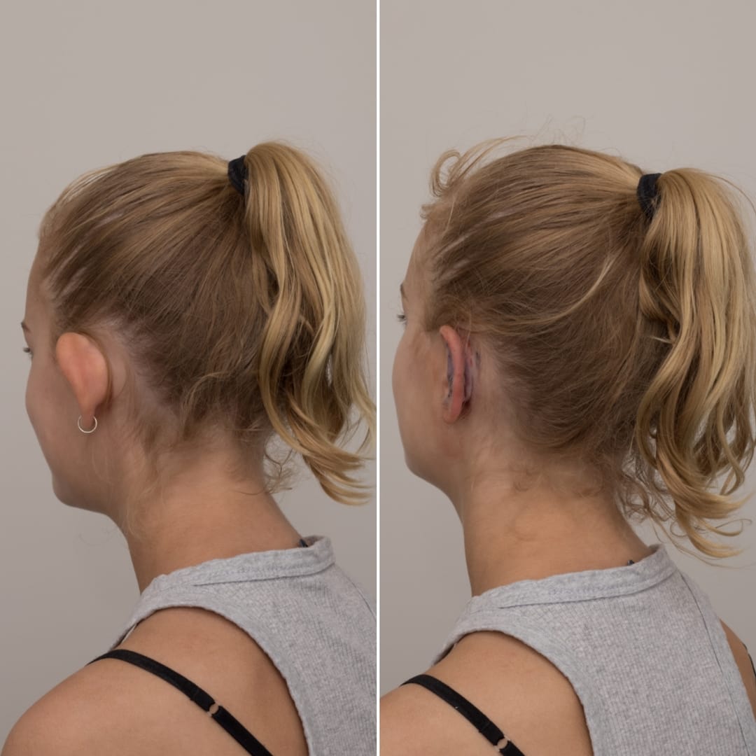 Suture Otoplasty | GMC Cosmedical Clinics, Sydney