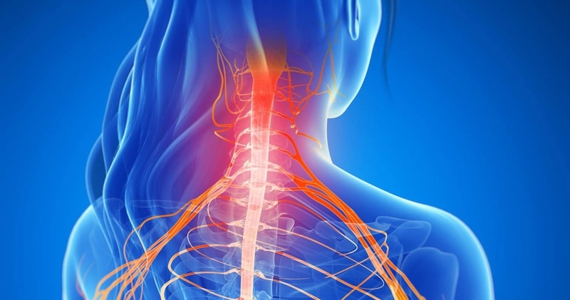 Neck Stinger/Burner - ESPMedicine