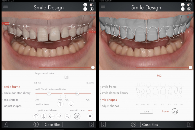 Digital Smile Design for Smile Makeovers
