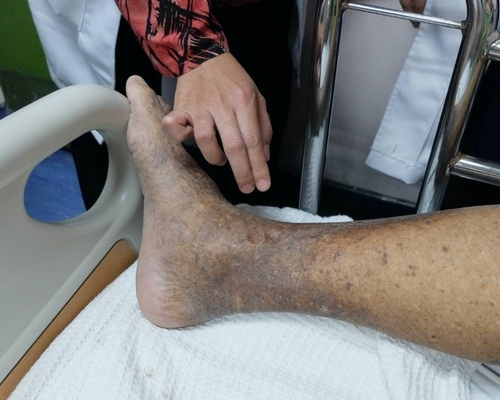 What is Peripheral (leg) Artery Disease? | Blog | South Valley Vascular