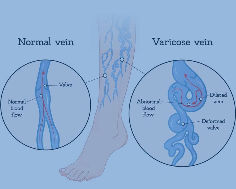 When Varicose Veins Become Painful: Here's Why | Blog | South Valley ...