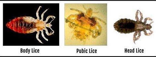 Lice in Lashes: Should you be Worried? | LiceDoctors