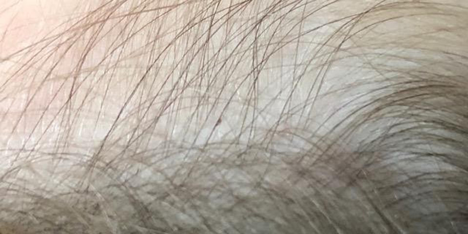 How to Check for Lice Eggs or Nits