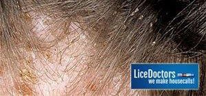 What Are the Symptoms of Lice?