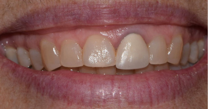Dental Before & Afters | Woburn Dental Associates