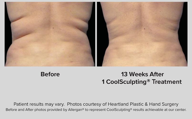 Dr. Sculpt® - Before and After Pictures