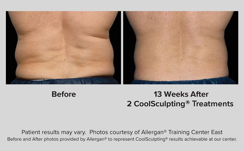 Dr. Sculpt® - Before and After Pictures
