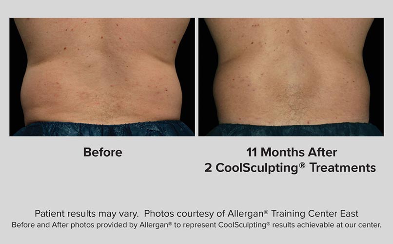 Dr. Sculpt® - Before and After Pictures