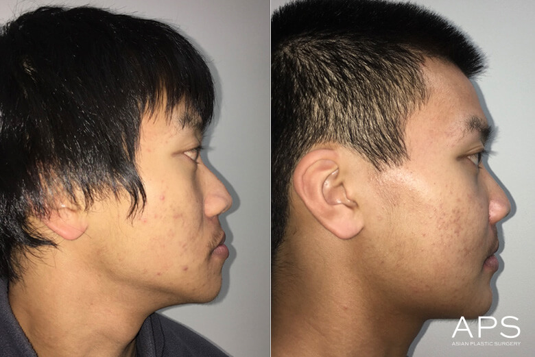 Facial Bone Contouring Before and After Photos For Asian Patients