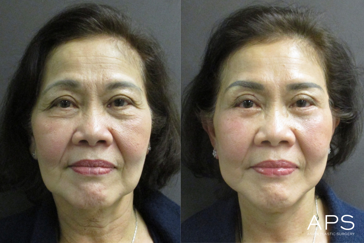 Facelift Before and After Photos For Asian Patients