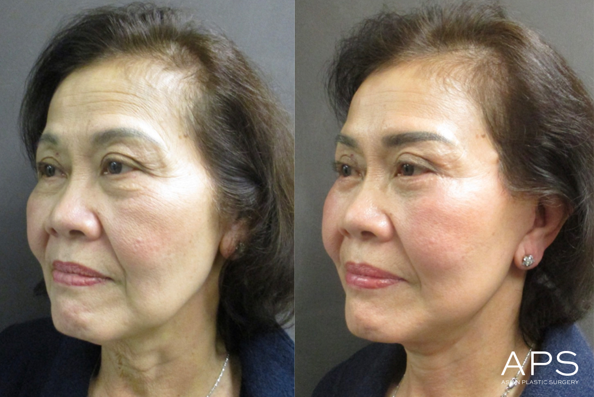 Facelift Before and After Photos For Asian Patients