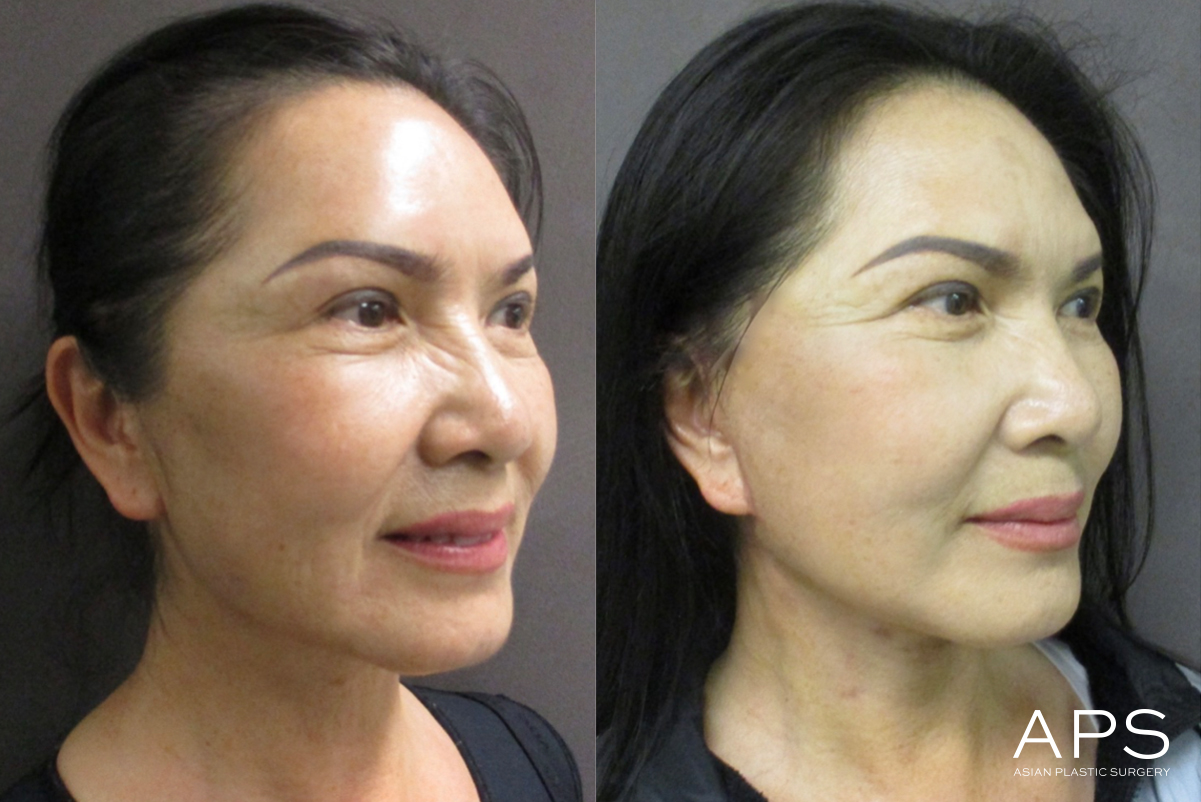 Facelift Before and After Photos For Asian Patients