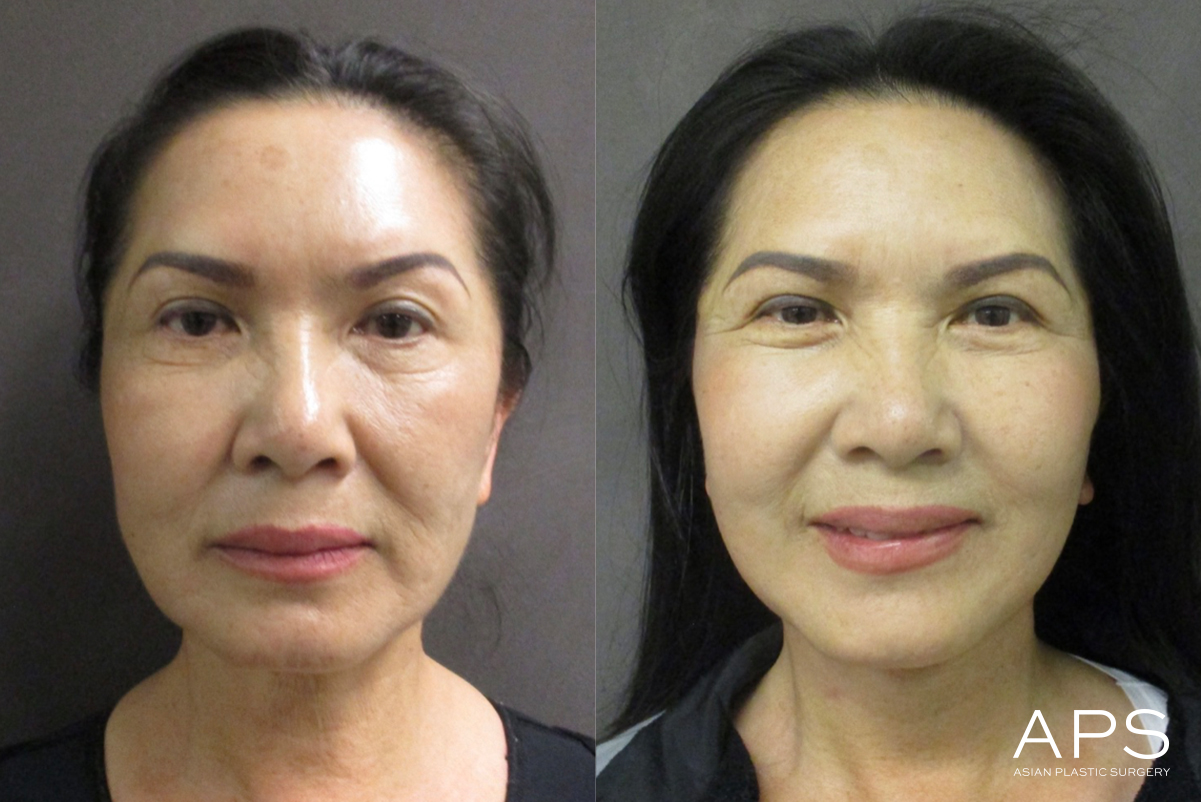 Facelift Before and After Photos For Asian Patients