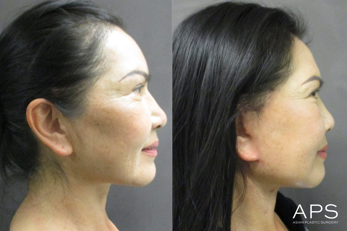 Facelift Before and After Photos For Asian Patients