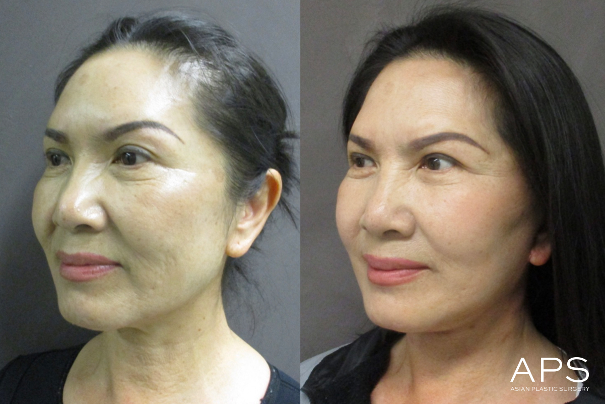 Facelift Before and After Photos For Asian Patients
