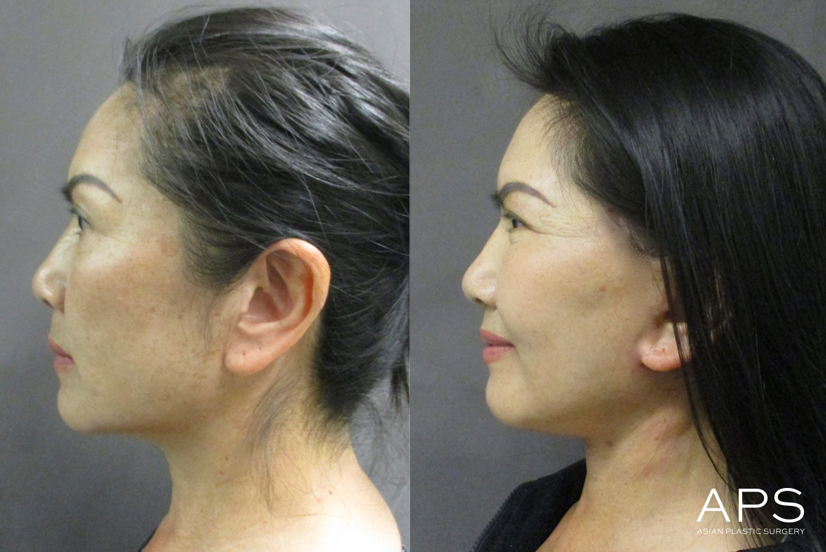 Facelift Before and After Photos For Asian Patients