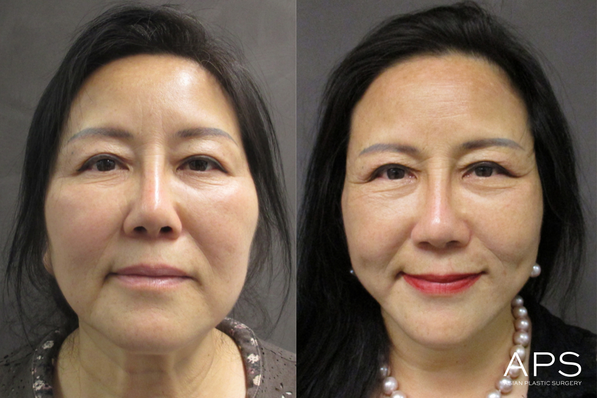 Facelift Before and After Photos For Asian Patients