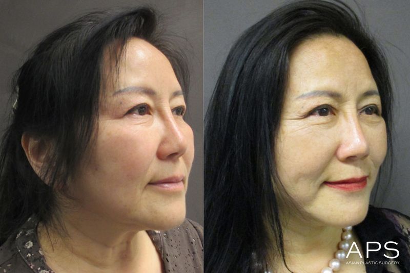 Facelift Before and After Photos For Asian Patients