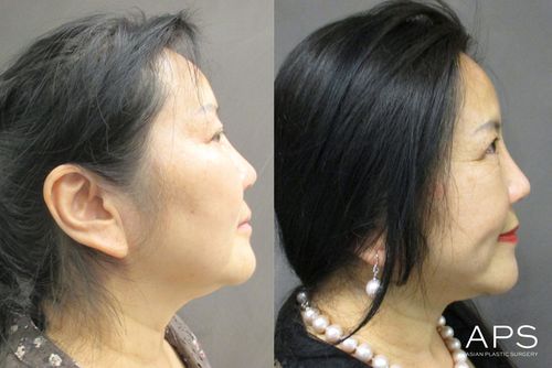 Facelift Before and After Photos For Asian Patients