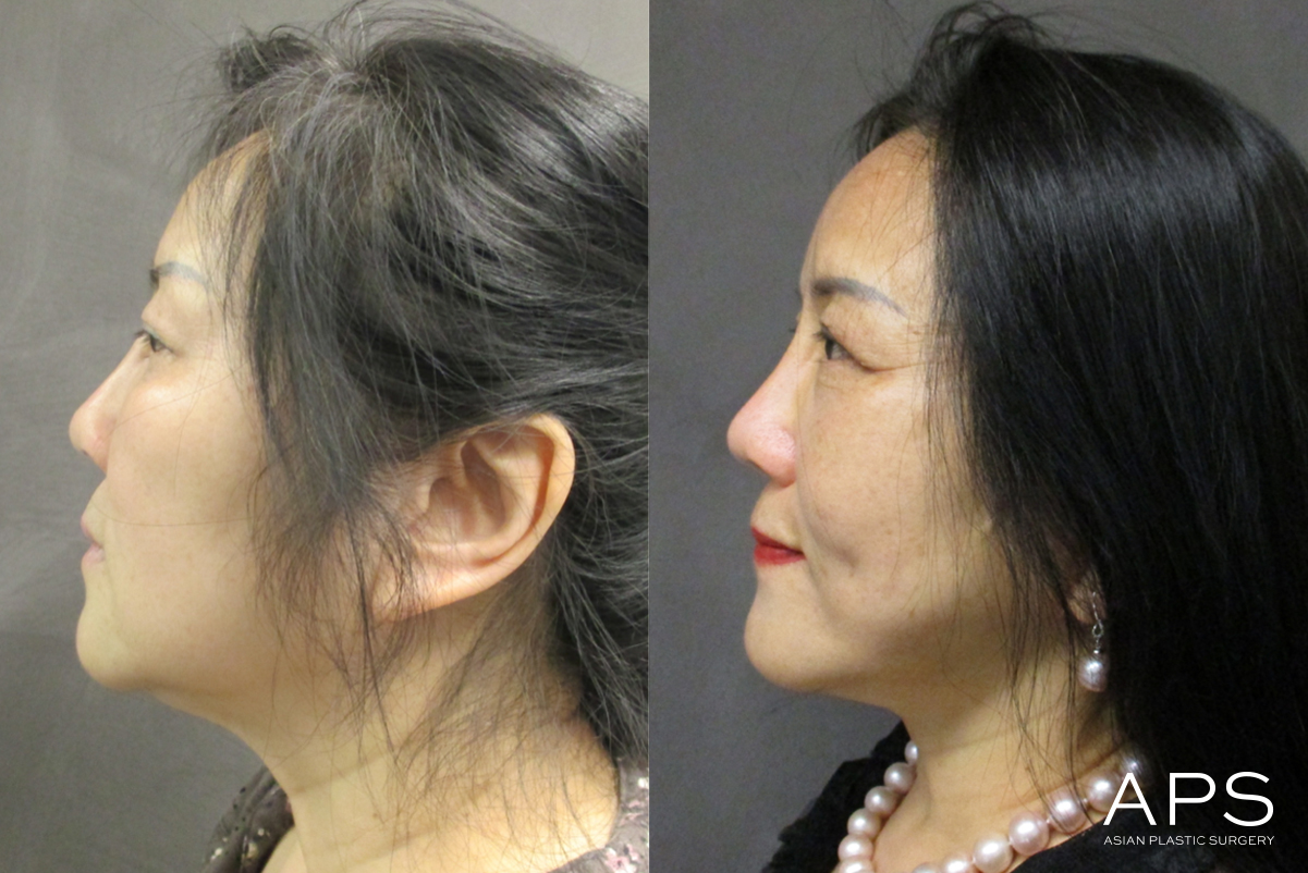 Facelift Before and After Photos For Asian Patients