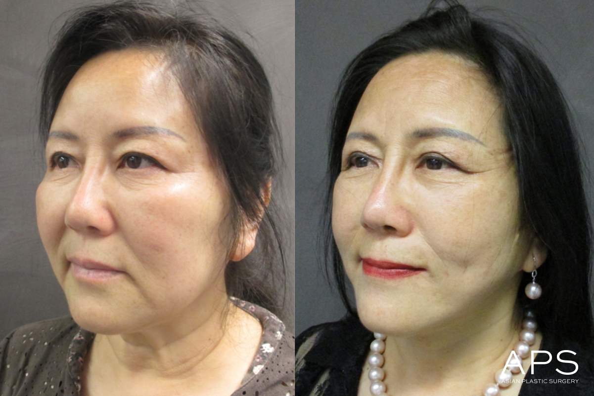 Facelift Before and After Photos For Asian Patients