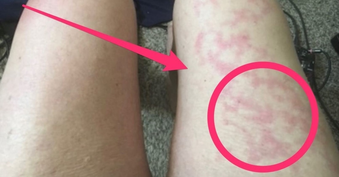 How to Get Rid of Hives after COVID-19 - Laredo Emergency Room