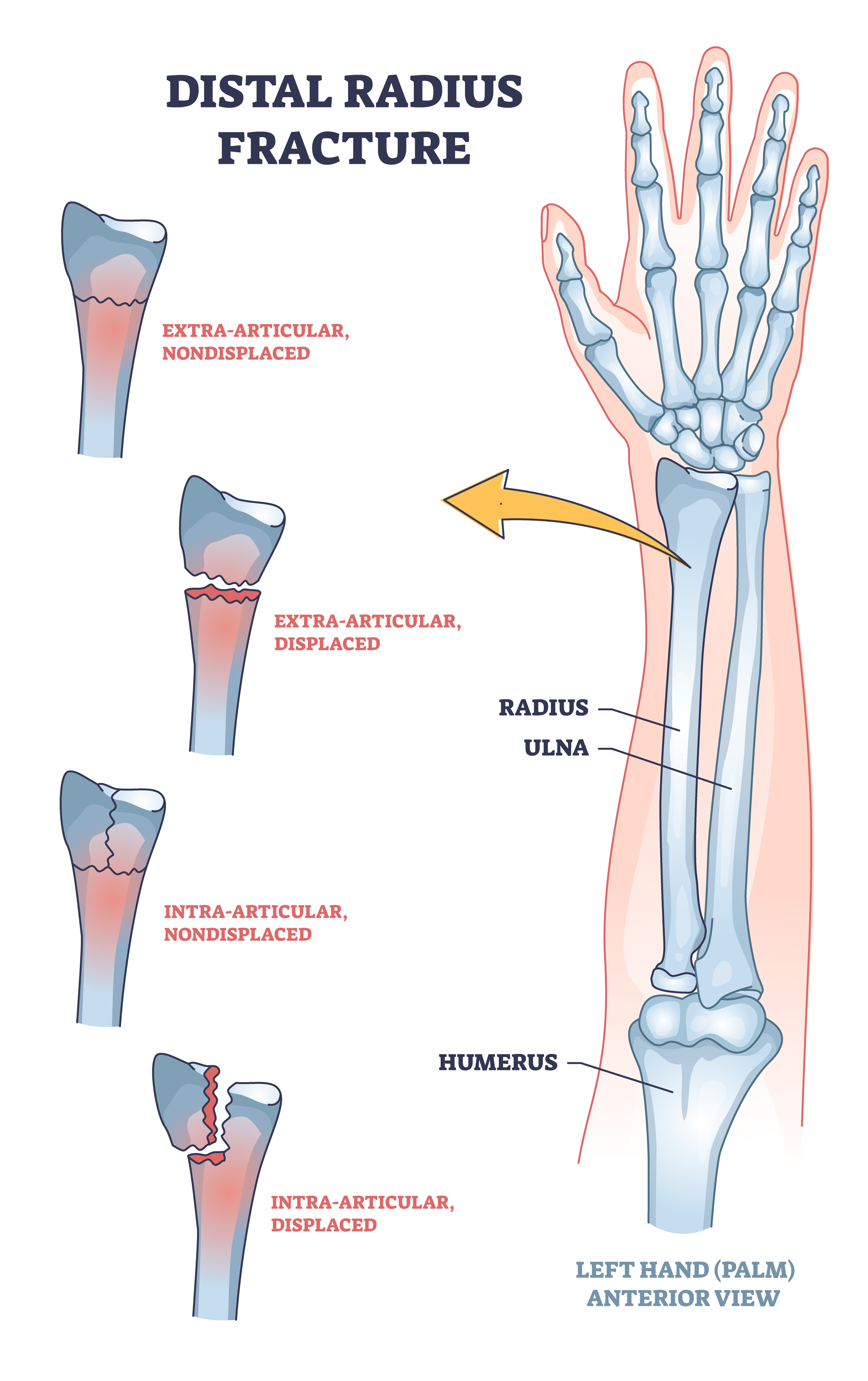 Distal Radius Fracture What Is It 